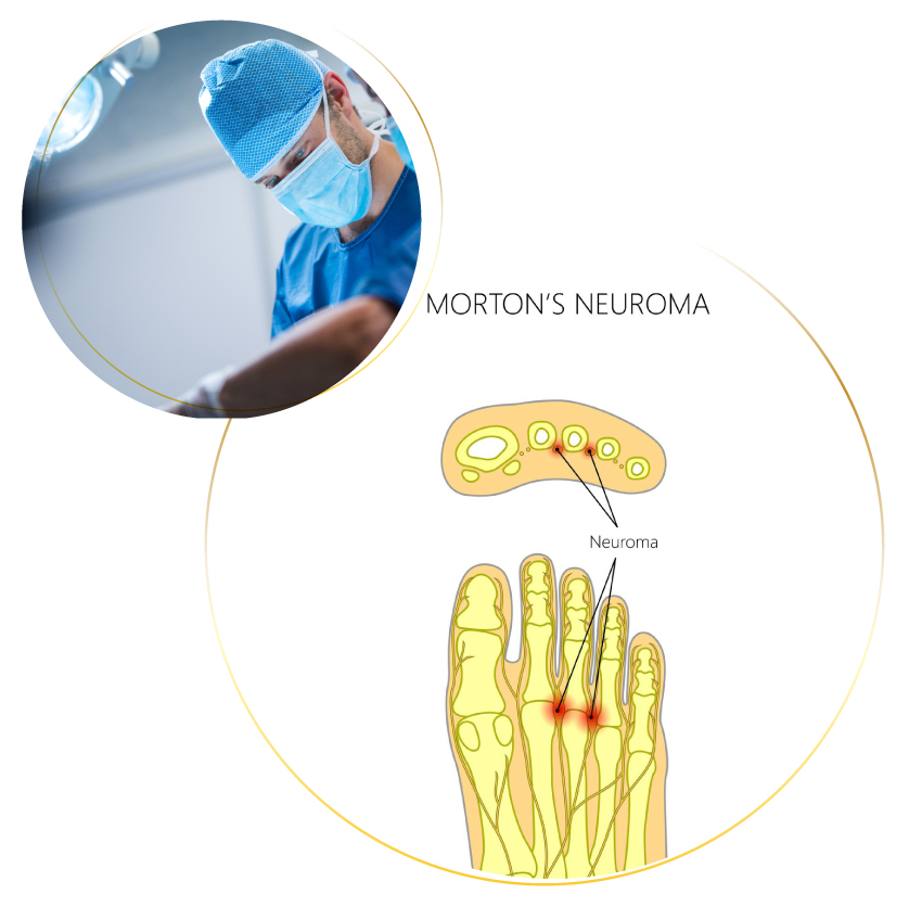 Morton’s Neuroma – Mark Trezia, DPM